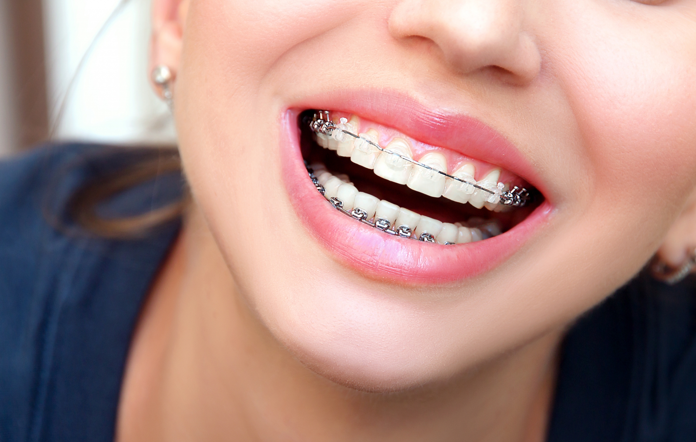 Ceramic braces store